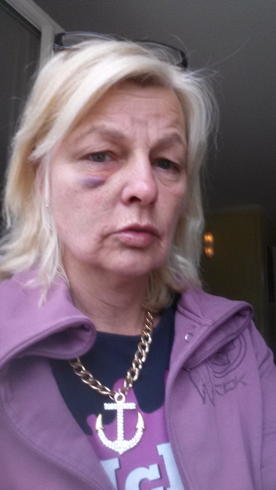 Frl. Menke mit blauem Auge - Seevetal